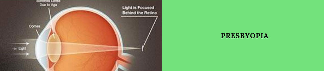Best Presbyopia Surgeon in Bangalore | Nelivigi Eye