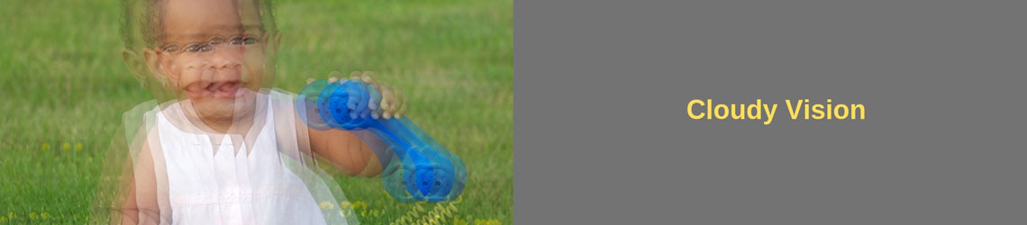 Best Eye Hospital in Bangalore for Cataract Surgery | Nelivigi