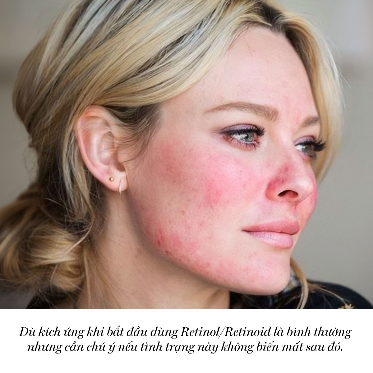 Ngưng Dùng Retinol Hay Retinoid Ngay Lập Tức Nếu Da Bạn Có 1 Trong 4
