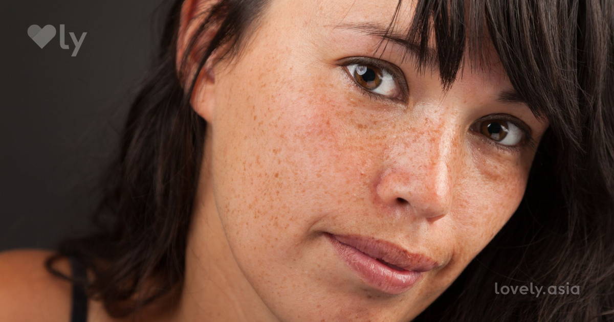 All Your Questions About Freckles and Making Them Work - Answered ...