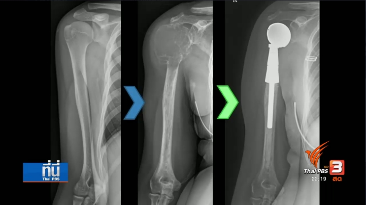 Locally-made proximal humerus endoprosthesis gives hope to bone cancer ...